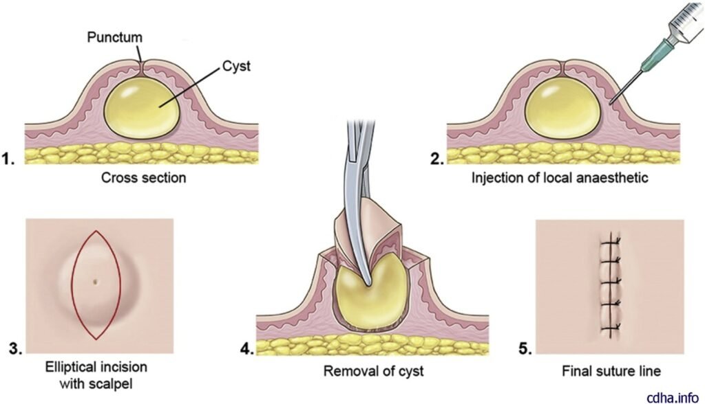 Cyst Removal in Cardiff | Local Anaesthetic | Excel Clinic