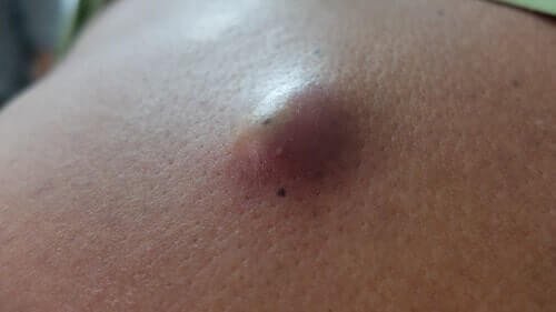 Cyst Removal in Cardiff | Local Anaesthetic | Excel Clinic